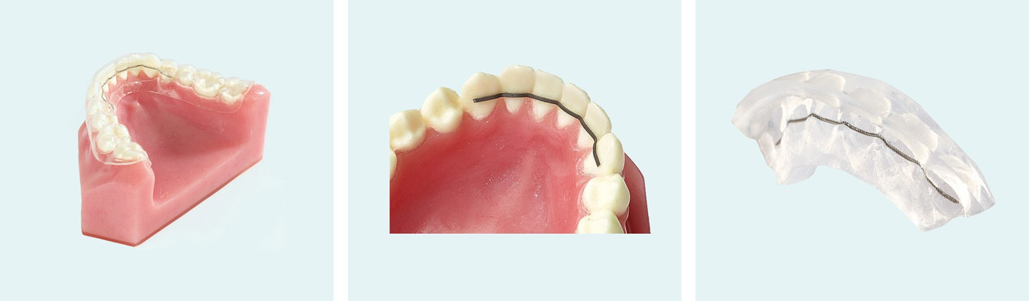 Retainers - JJ Thompson Orthodontic Appliances